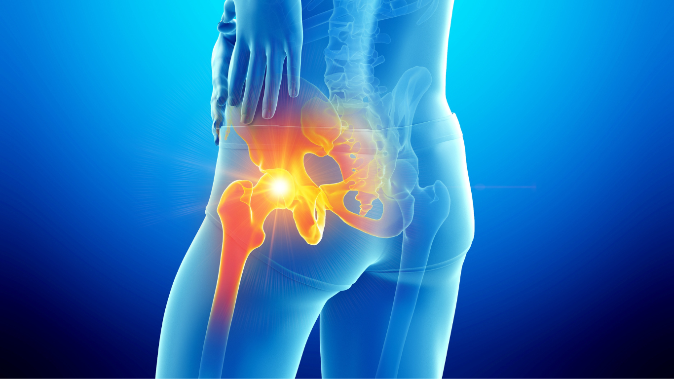 poor hip and Gluteal muscle control gold coast physio | Gold Coast ...