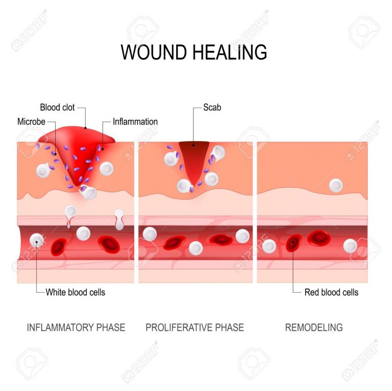 wound healing process. Tissue injury and inflammation. | Gold Coast ...