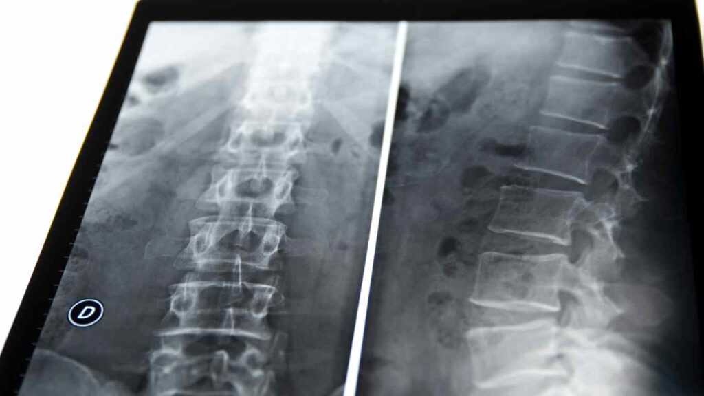 Xray Back | Gold Coast Physio & Sports Health | Ashmore & Burleigh