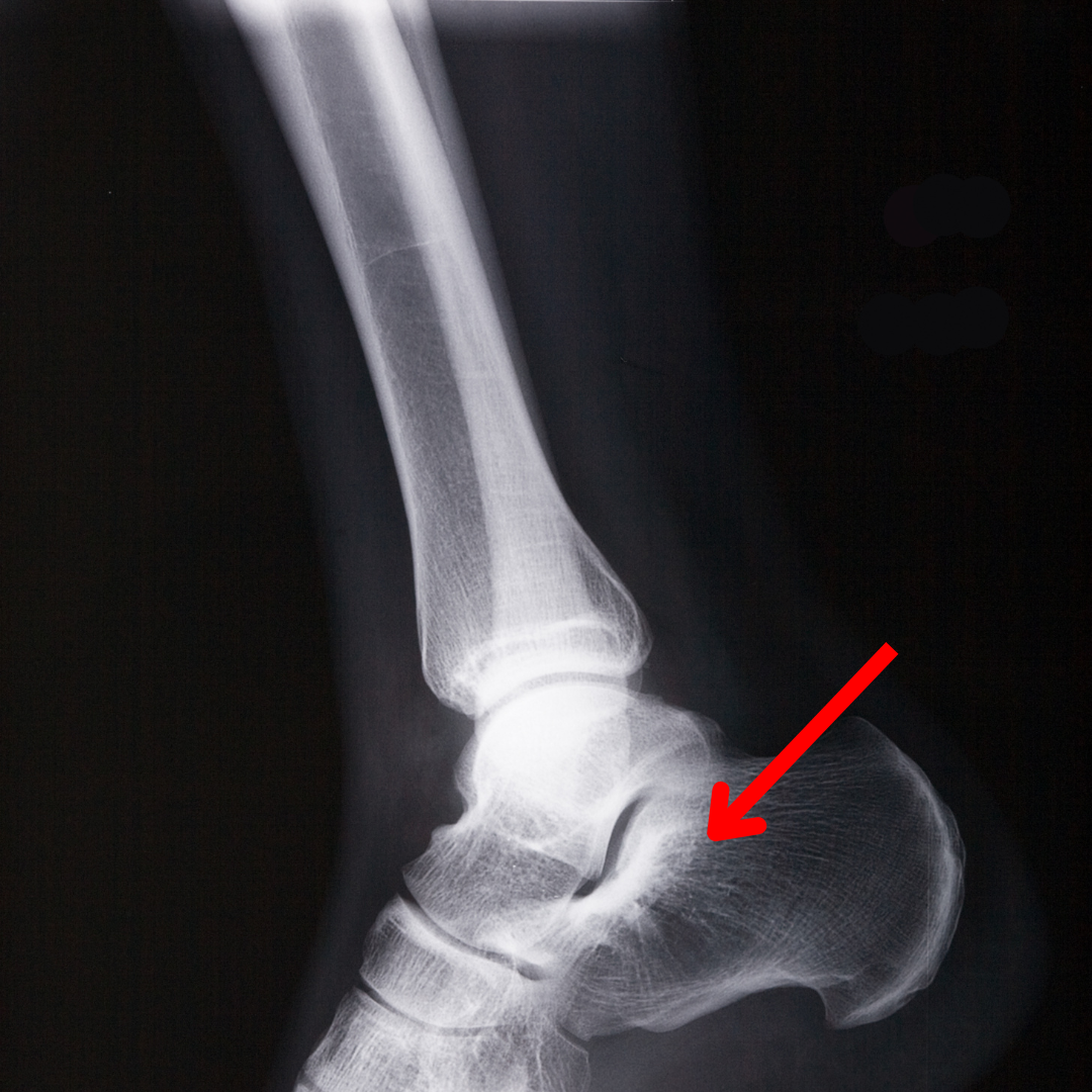 How do you know if you have a bone stress facture? | Gold Coast Physio ...